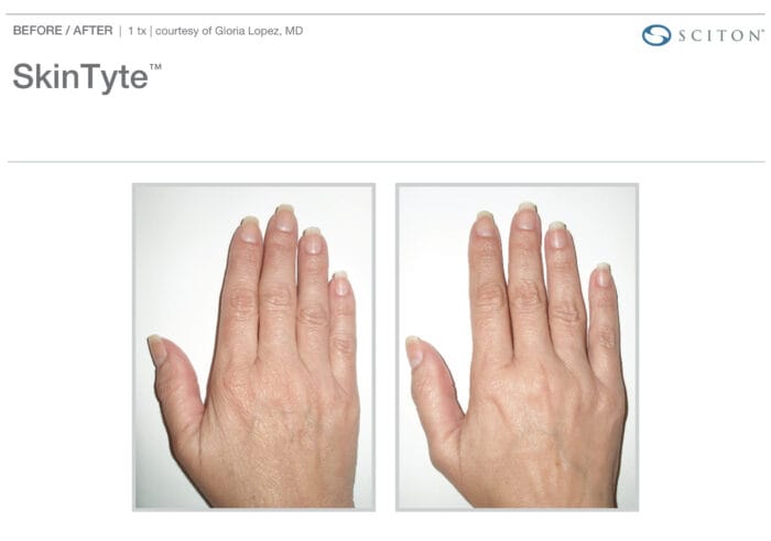 SkinTyte | Skin Tightening Laser Treatment | Bournemouth