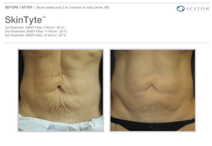 SkinTyte | Skin Tightening Laser Treatment | Bournemouth