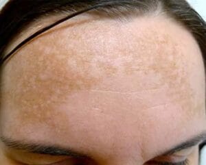 How do I get rid of brown patches on my face?